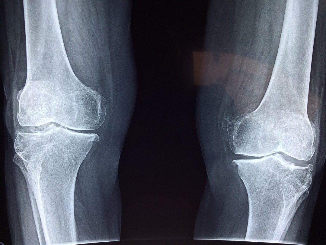Limbex Review - Will It Really Help With Your Joint Issues?
