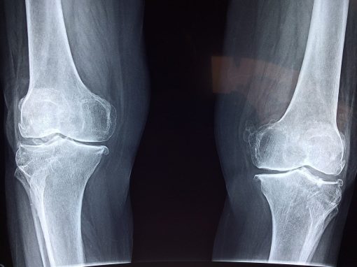 Limbex Review - Will It Really Help With Your Joint Issues?